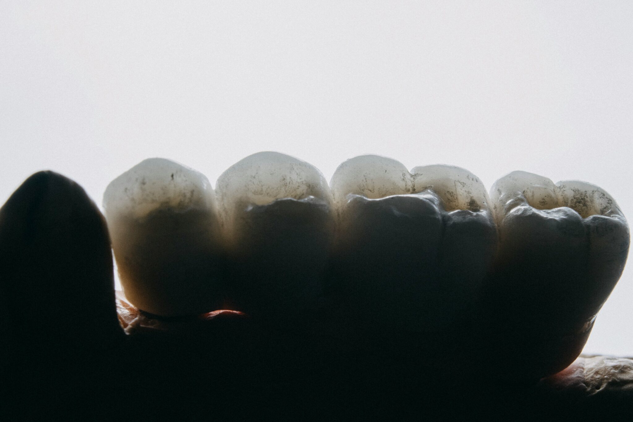 Zirconia Crown Comparison: Bruxzir vs 3M vs Emax Explained - Health