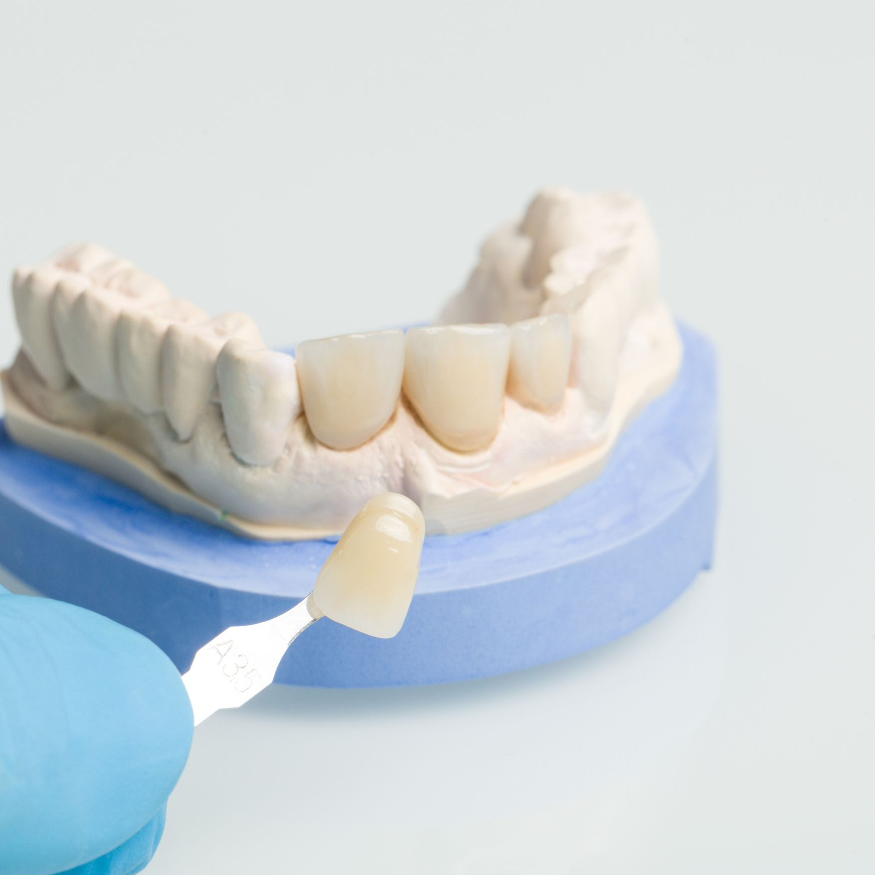 Zirconia Crown Comparison: Bruxzir vs 3M vs Emax Explained - Health